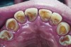 Dentin Hypersensitivity: An Update on Diagnosis and Etiology | Inside ...